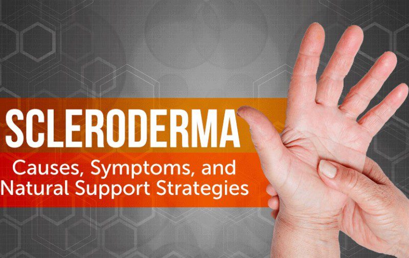 Scleroderma Types Causes Natural Treatment Arabic Herbal Medicine